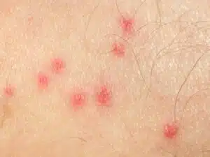 I Migliori Rimedi per Puntura di Cimici da Letto